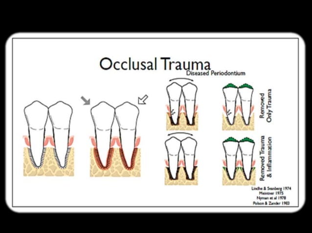 Trauma oclusal orto perio Dr. Nelson Mendoza | PPTX | Death, Injury, or ...