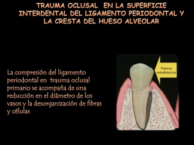 Trauma oclusal orto perio Dr. Nelson Mendoza | PPTX | Death, Injury, or ...