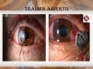 Trauma ocular | PPT