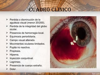Trauma ocular | PPT