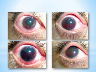 Trauma ocular cerrado | PPTX