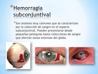 Trauma ocular cerrado | PPTX