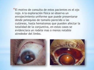Trauma ocular cerrado | PPTX