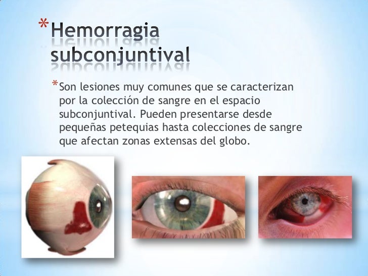 Hemorragia Subconjuntival