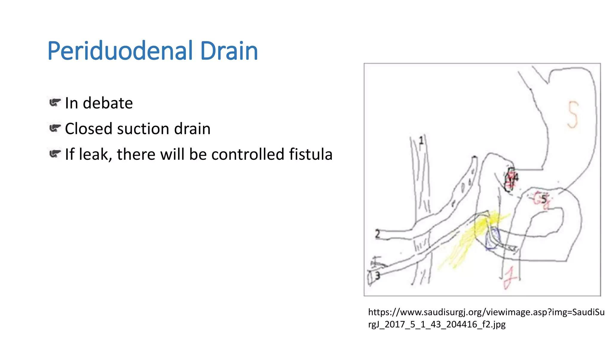 Trauma of duodenum | PPT