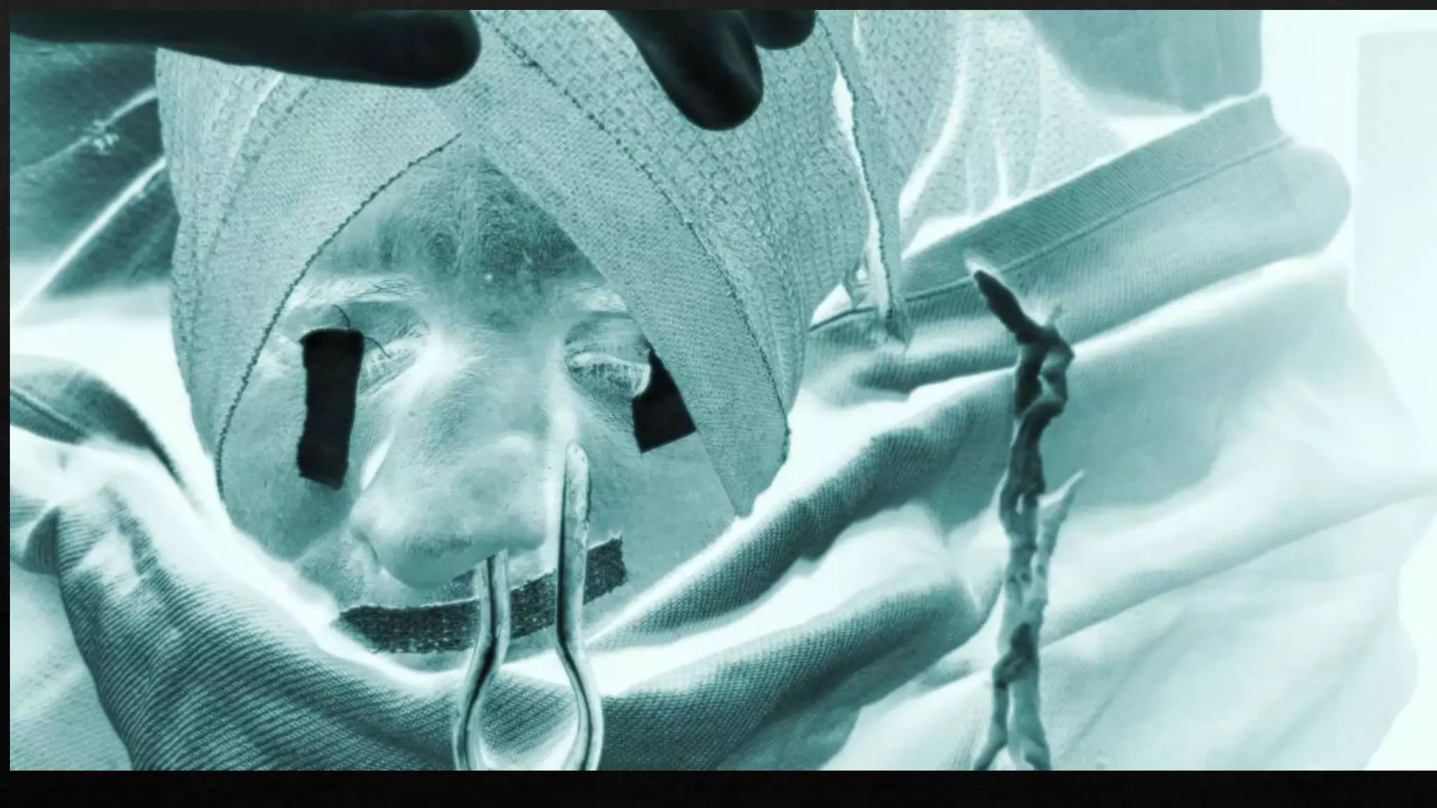 TRAUMA OF FACE.pptx