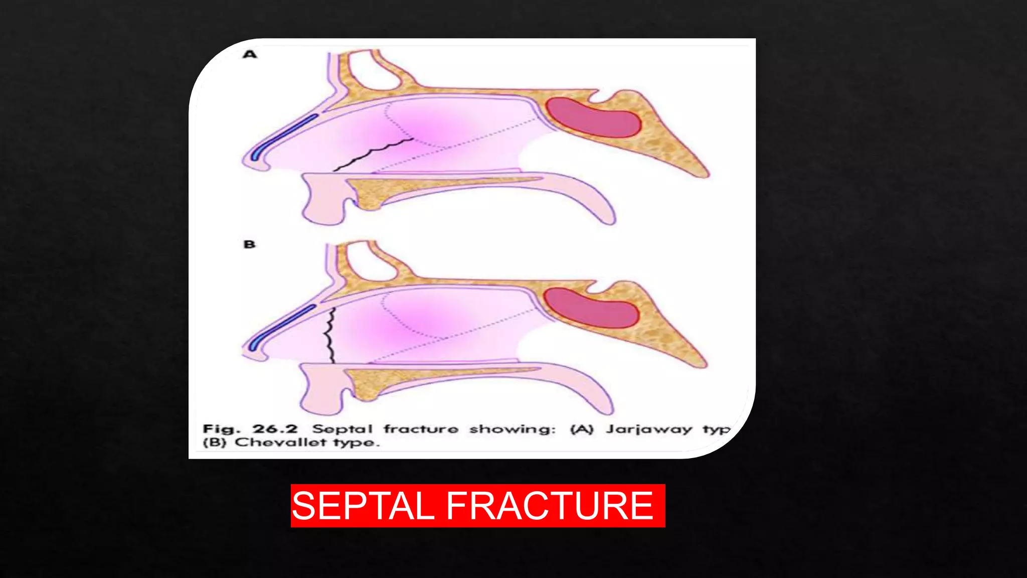 TRAUMA OF FACE.pptx