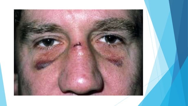 Trauma of nose.pptx