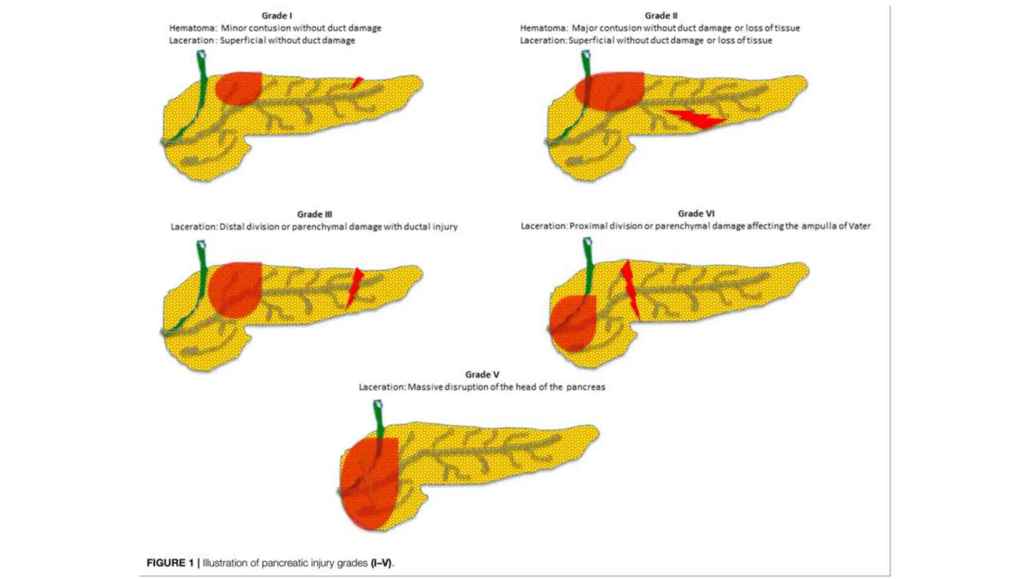 TRAUMA PANCREATICO, DIAGNOSTICO, TRATAMINETO , CLASIFIACION Y MANEJO.pptx