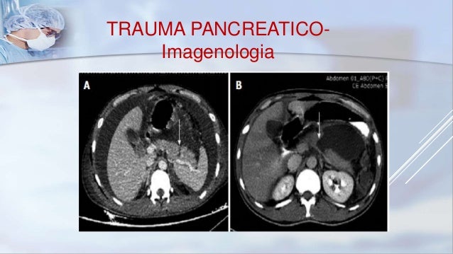 Trauma Pancreatico