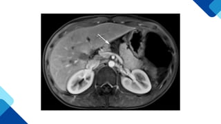 trauma de pancreas segun sociedad mundial | PPTX