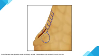 trauma de pancreas segun sociedad mundial | PPTX