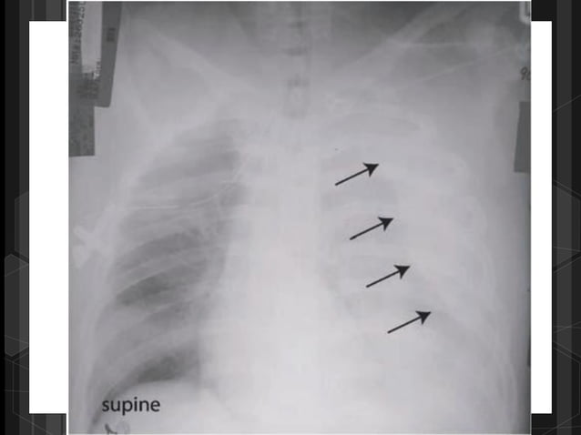 Trauma part 2 chest, abdomen, pelvic head and spine injury | PDF ...