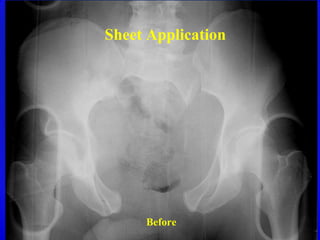 Trauma pelvic fracture ortho prespective | PPT