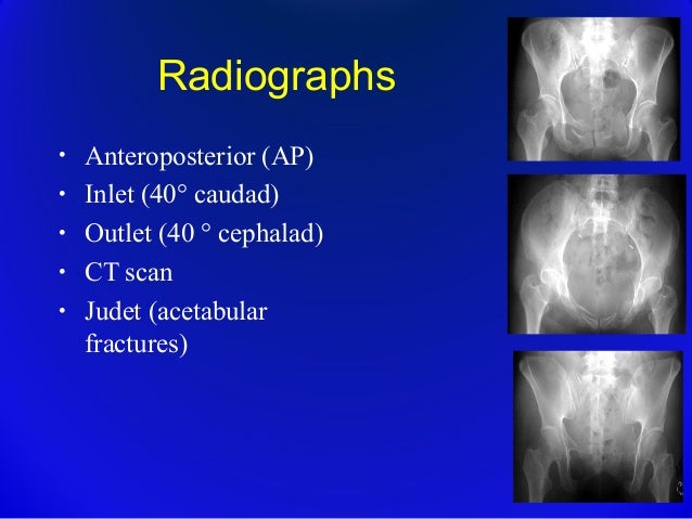 Trauma pelvic fracture ortho prespective