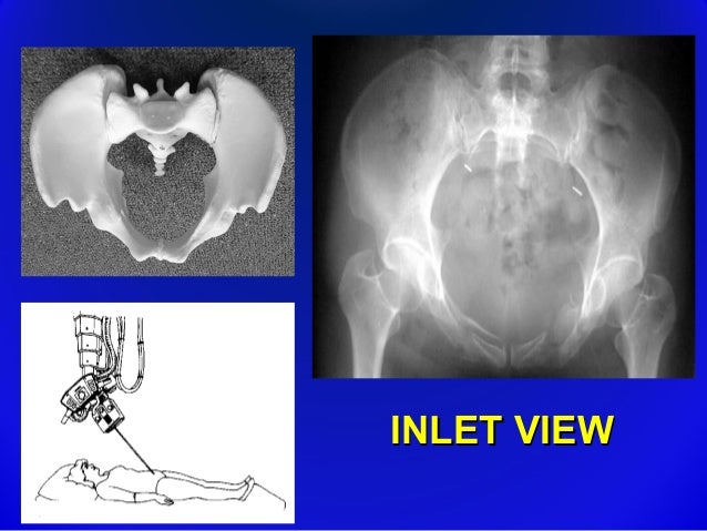 Trauma pelvic fracture ortho prespective