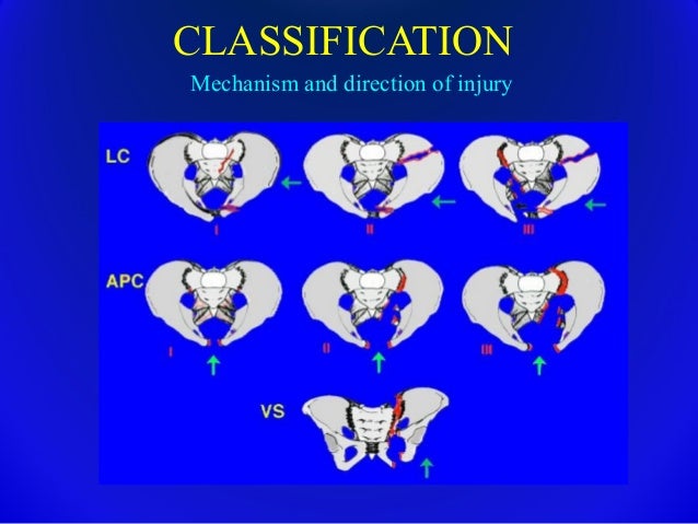Trauma pelvic fracture ortho prespective
