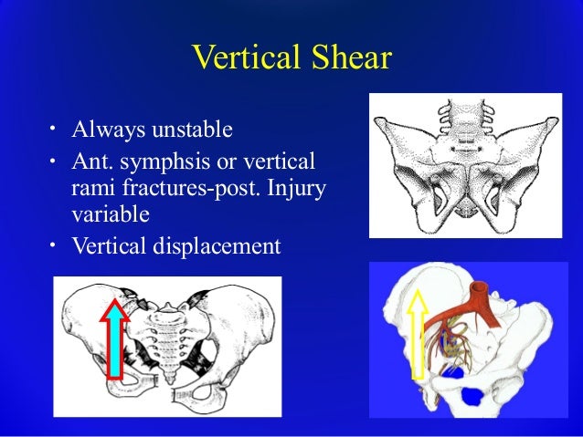 Trauma pelvic fracture ortho prespective