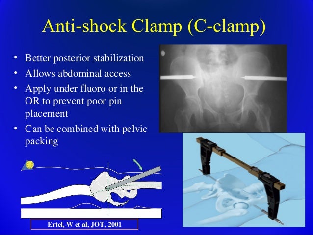 Trauma pelvic fracture ortho prespective