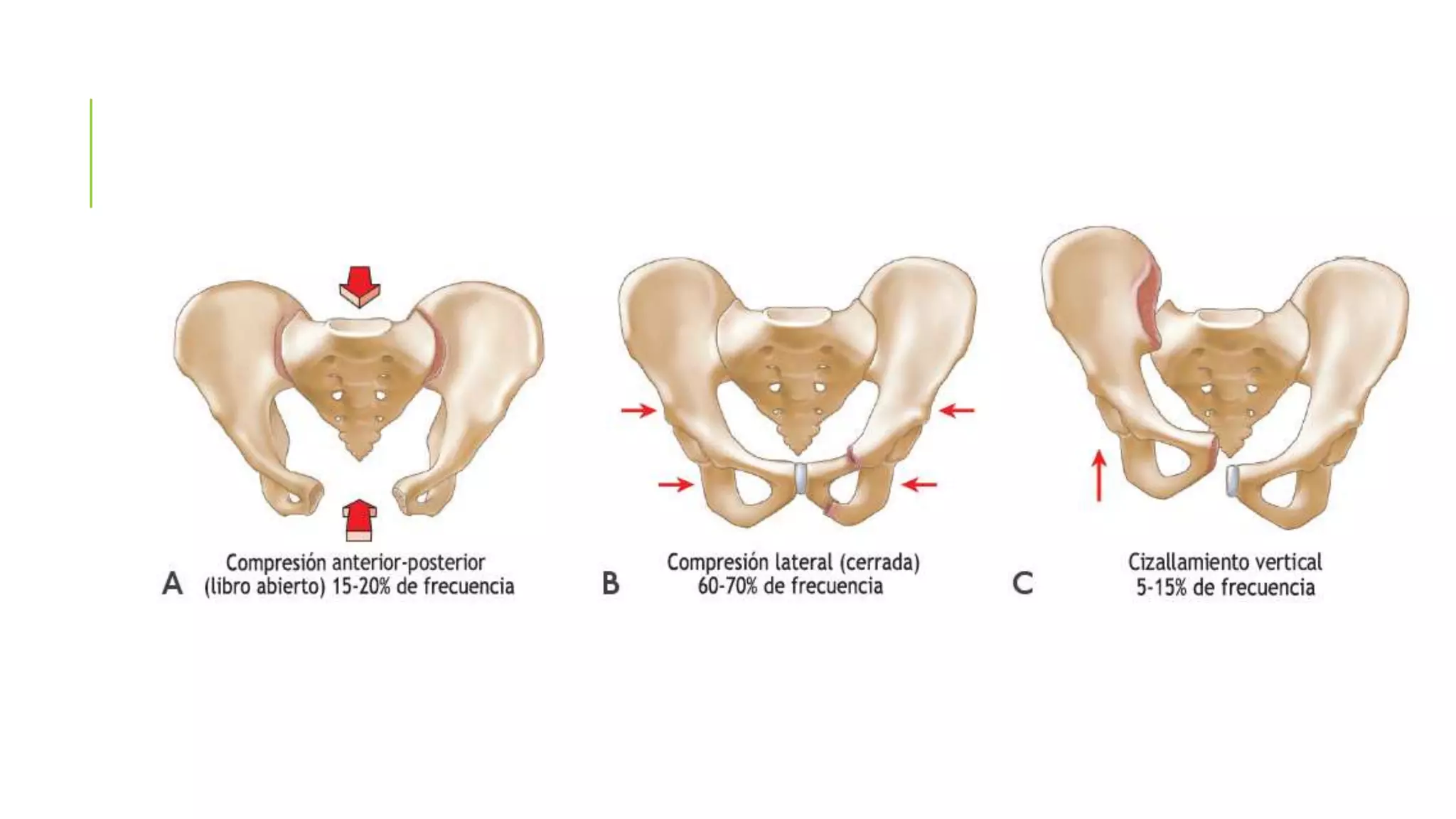 TRAUMA PÉLVICO Y ANORECTAL | PPT