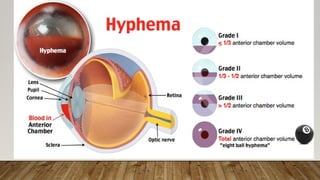 post traumatic glaucoma ( secondary glaucoma) | PPTX