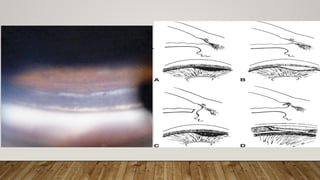 post traumatic glaucoma ( secondary glaucoma) | PPTX