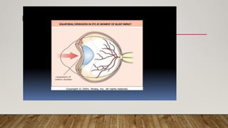 post traumatic glaucoma ( secondary glaucoma) | PPTX