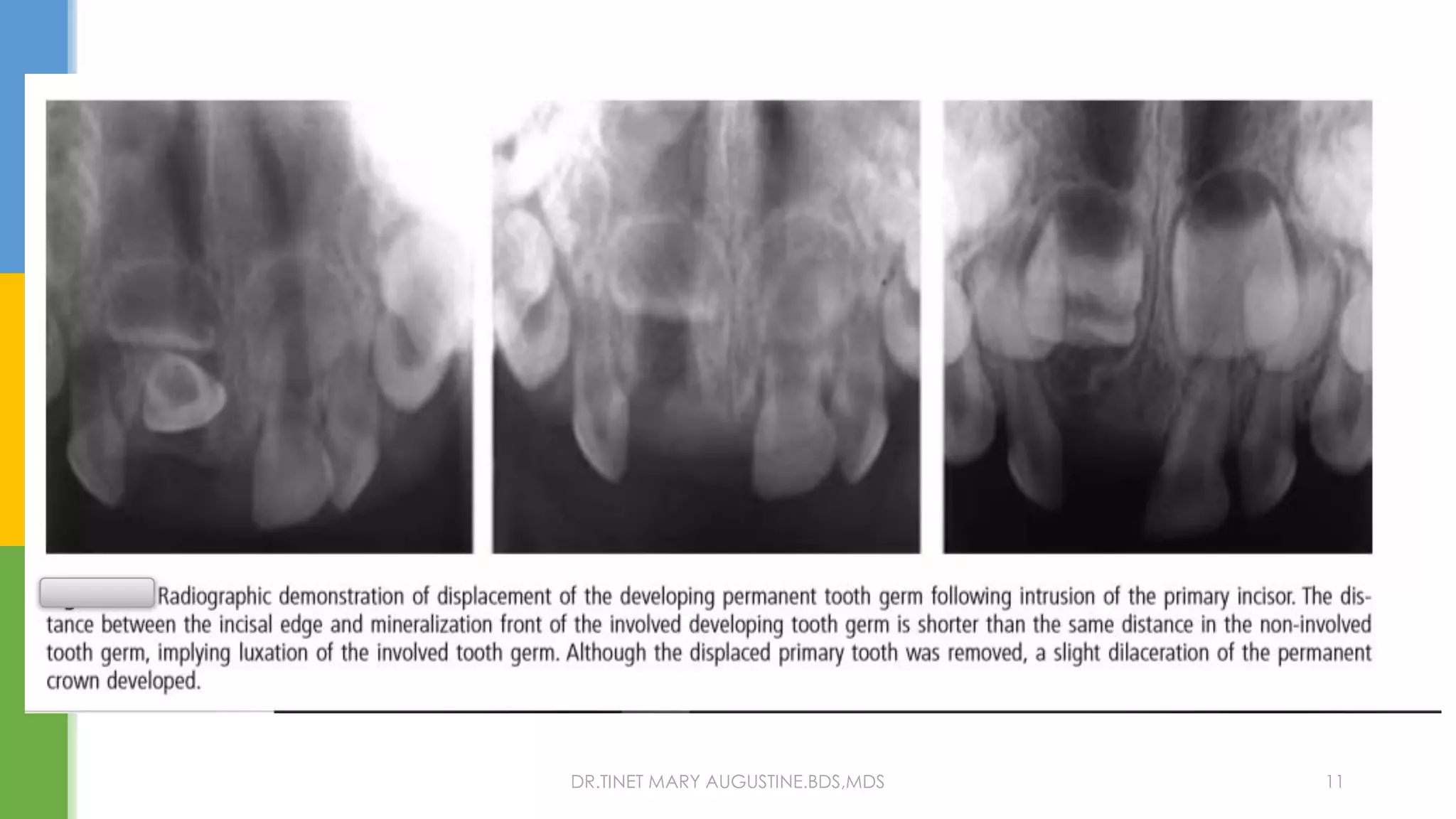 Traumatic injury to the primary dentition | PDF