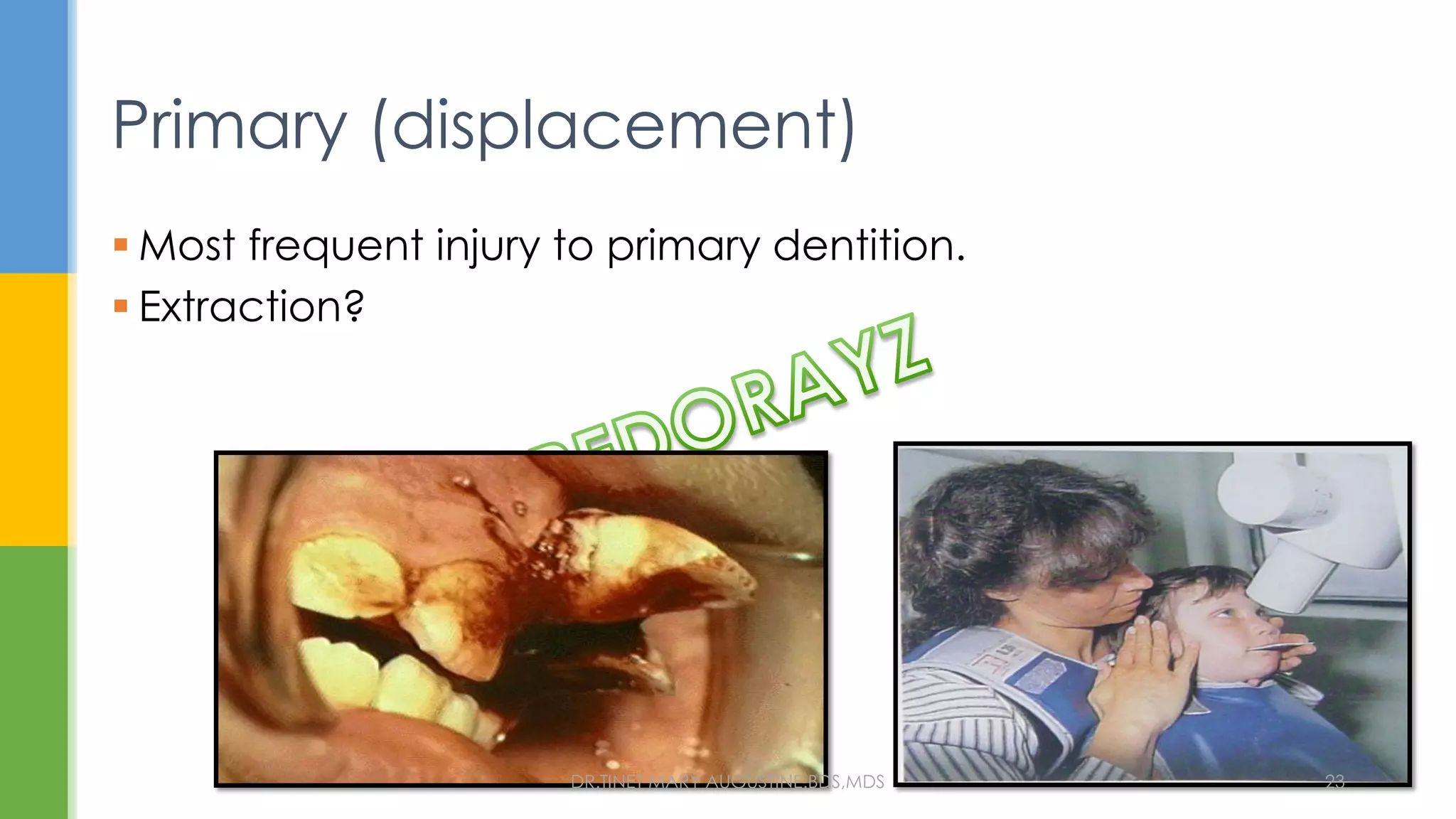 Traumatic injury to the primary dentition | PDF