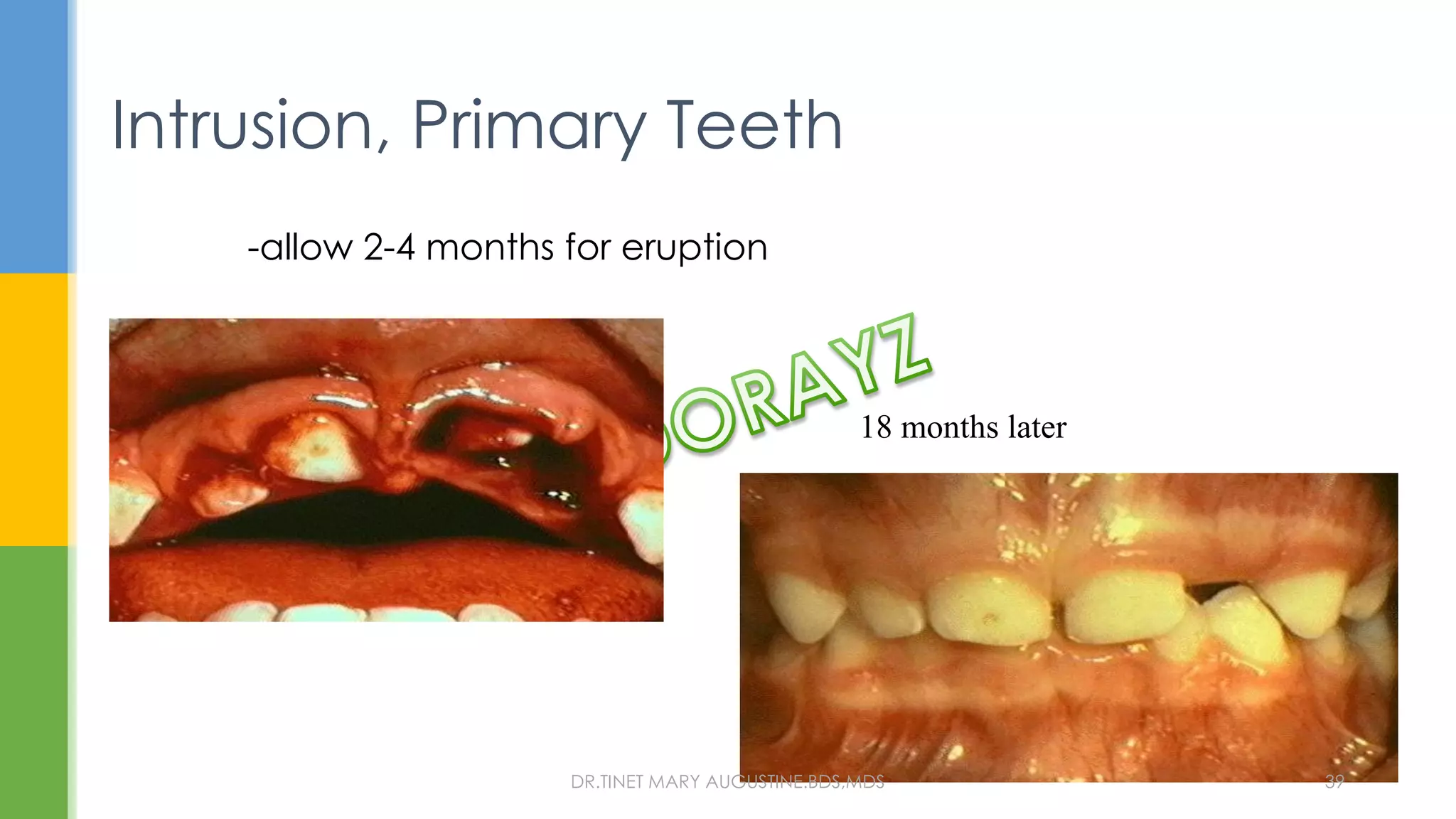 Traumatic injury to the primary dentition | PDF