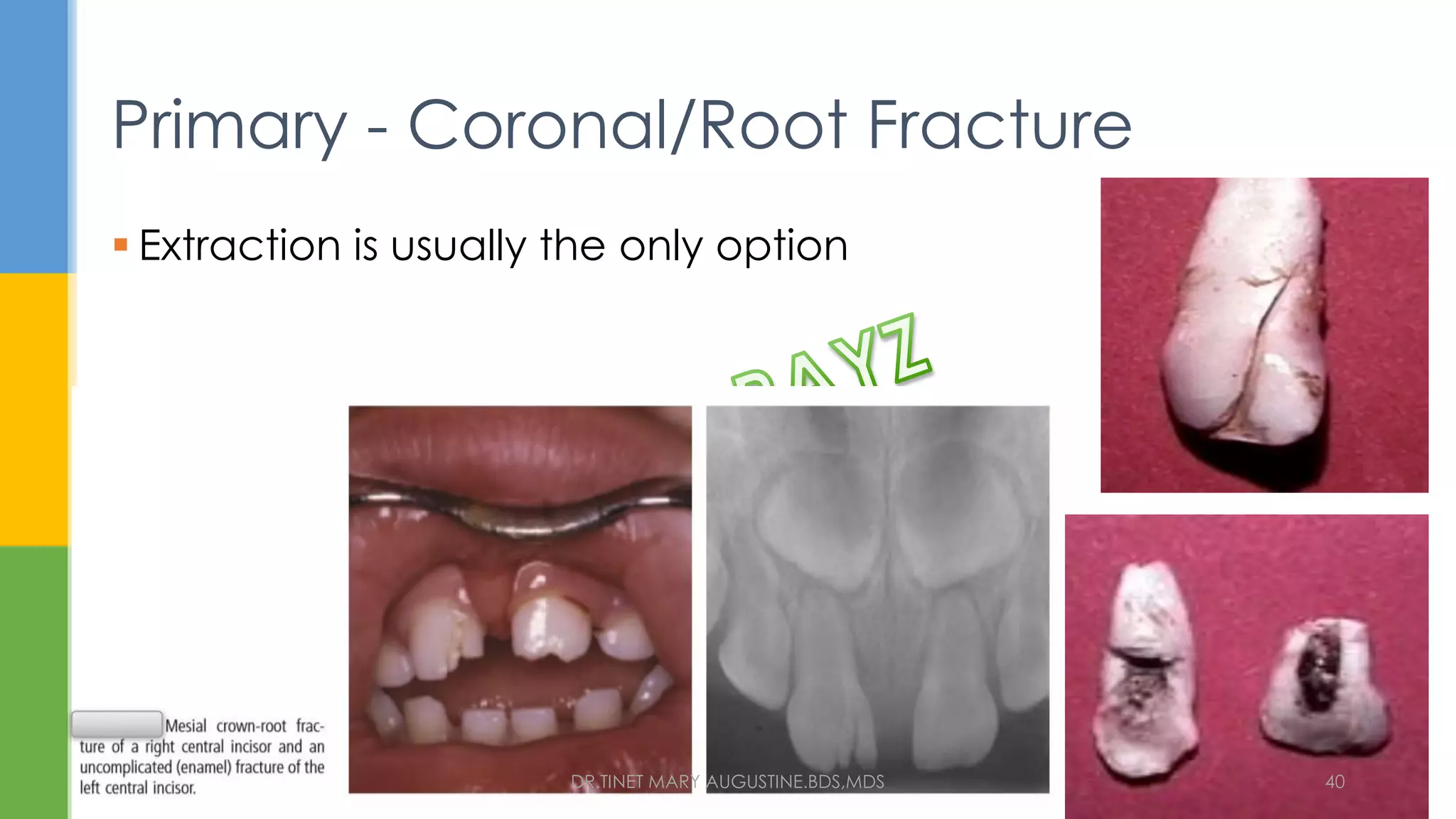 Traumatic injury to the primary dentition | PDF