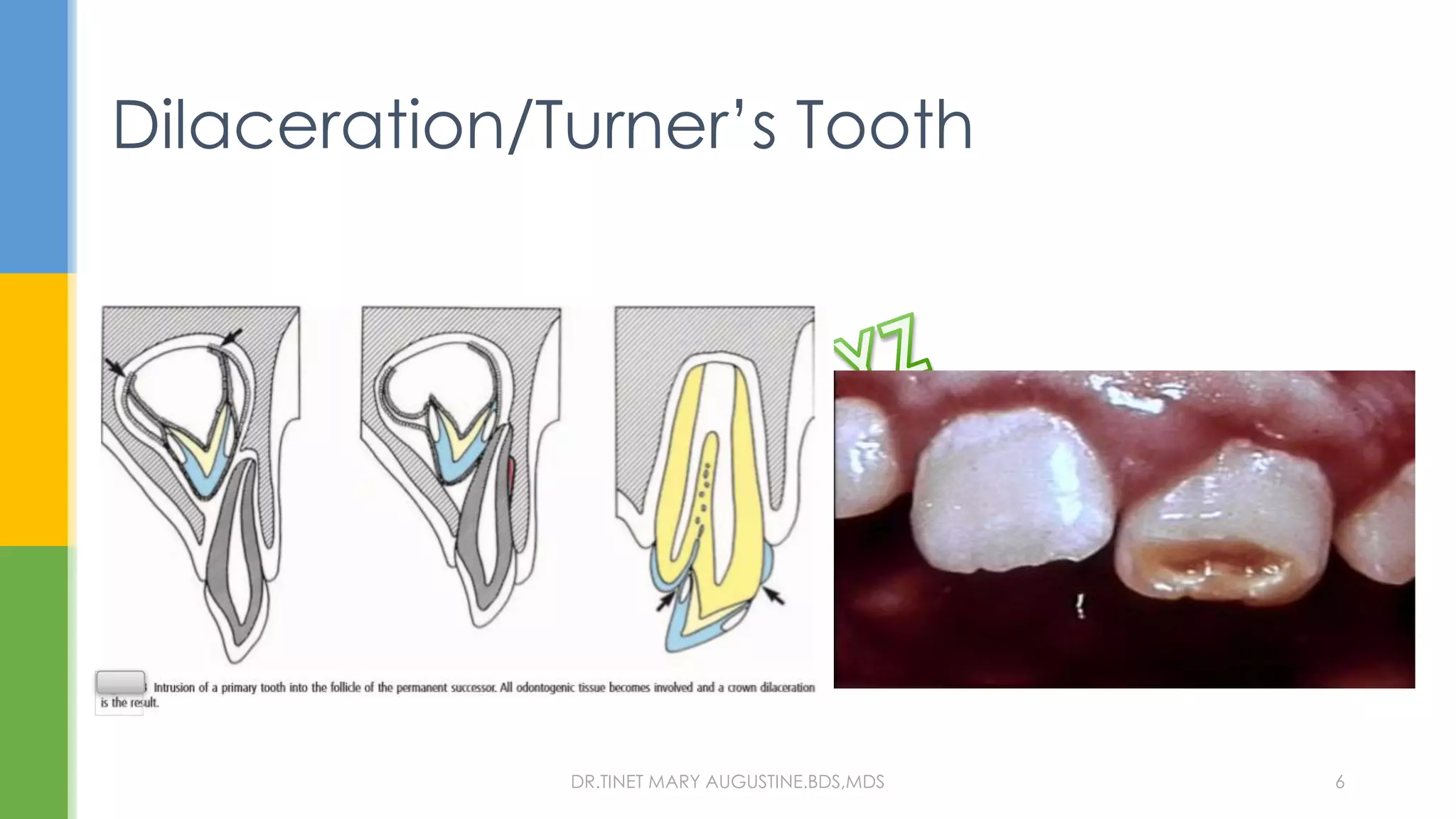 Traumatic injury to the primary dentition | PDF