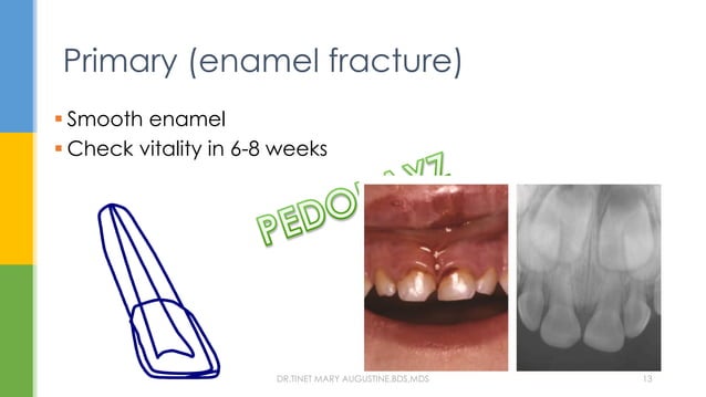 Traumatic injury to the primary dentition | PDF | Dental Health ...