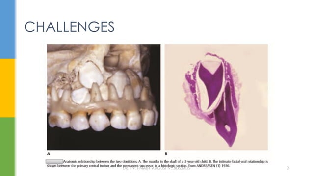 Traumatic injury to the primary dentition | PDF | Dental Health ...