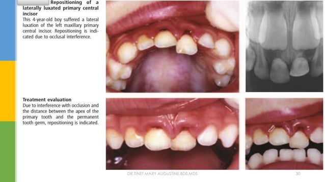 Traumatic injury to the primary dentition | PDF | Dental Health ...
