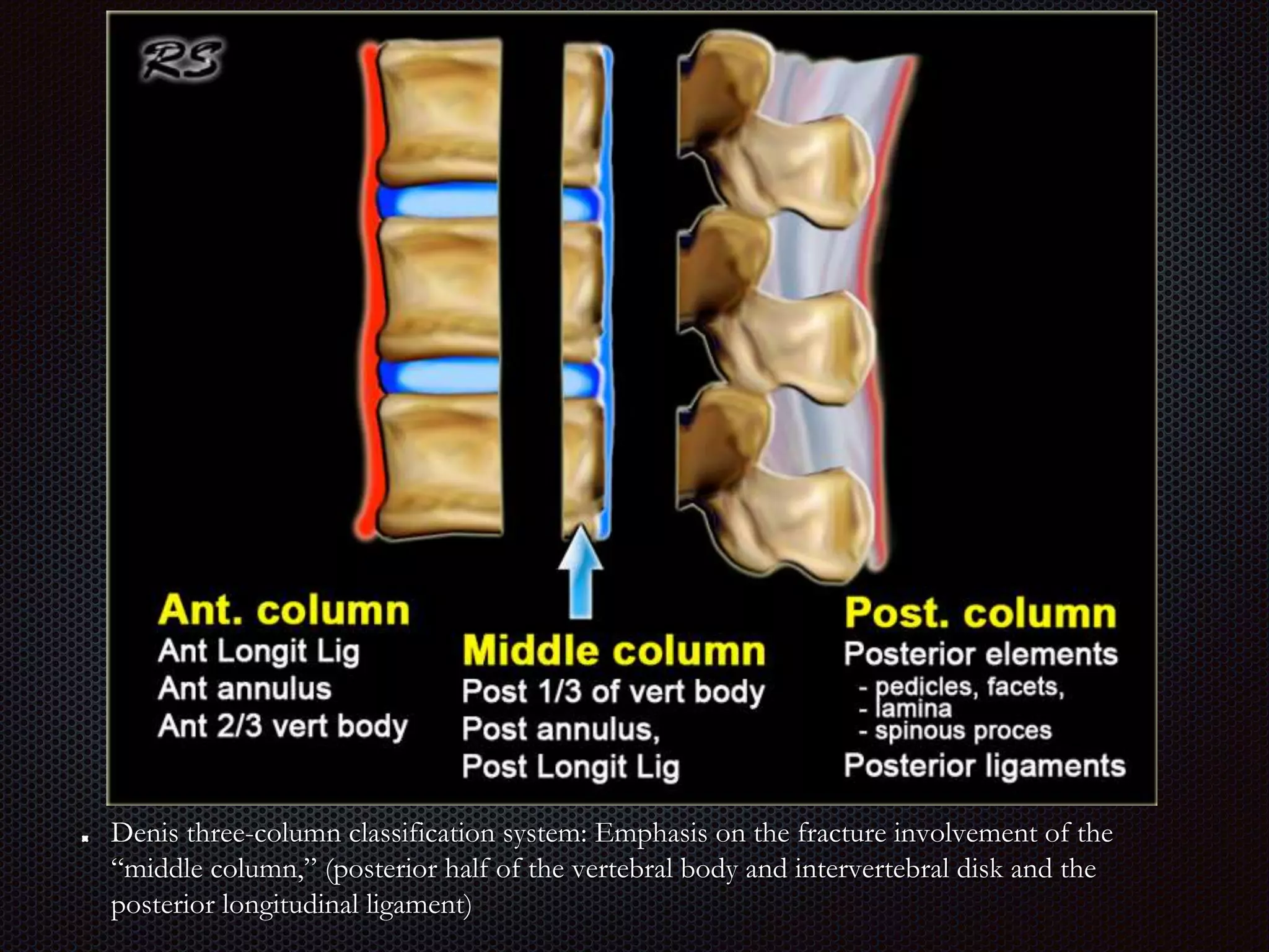 Imaging of thoracic spine Trauma | PPTX