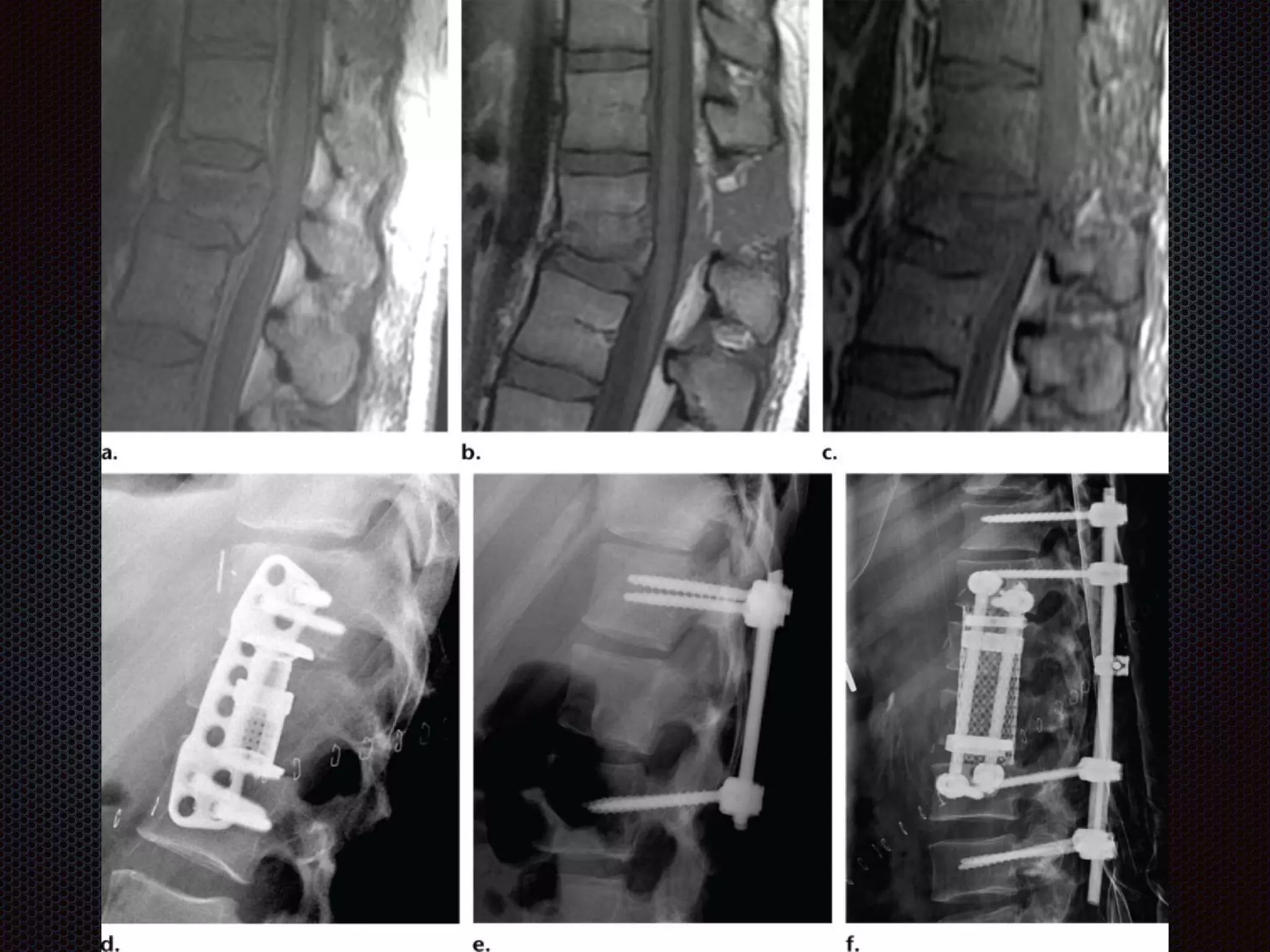 Imaging of thoracic spine Trauma | PPTX