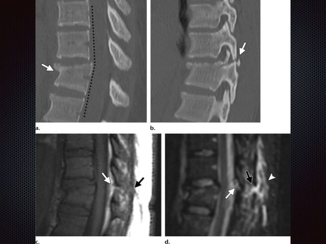 Imaging of thoracic spine Trauma | PPTX