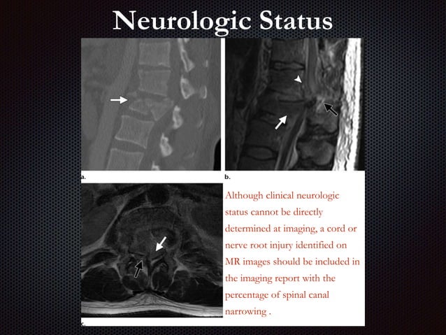 Imaging of thoracic spine Trauma | PPTX