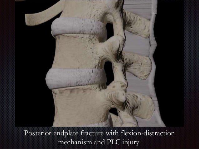 Imaging of thoracic spine Trauma