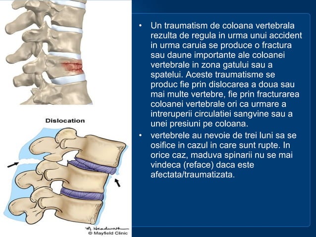 Traumat.vertebro medulare | PPT