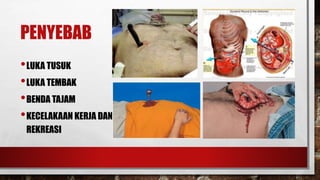 Trauma tajam abdomen dan penanganannya.pptx