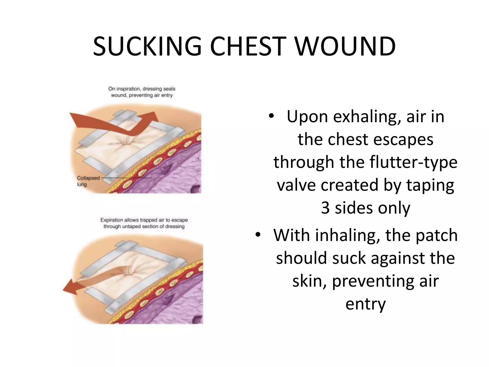 Trauma Thoraks.ppt