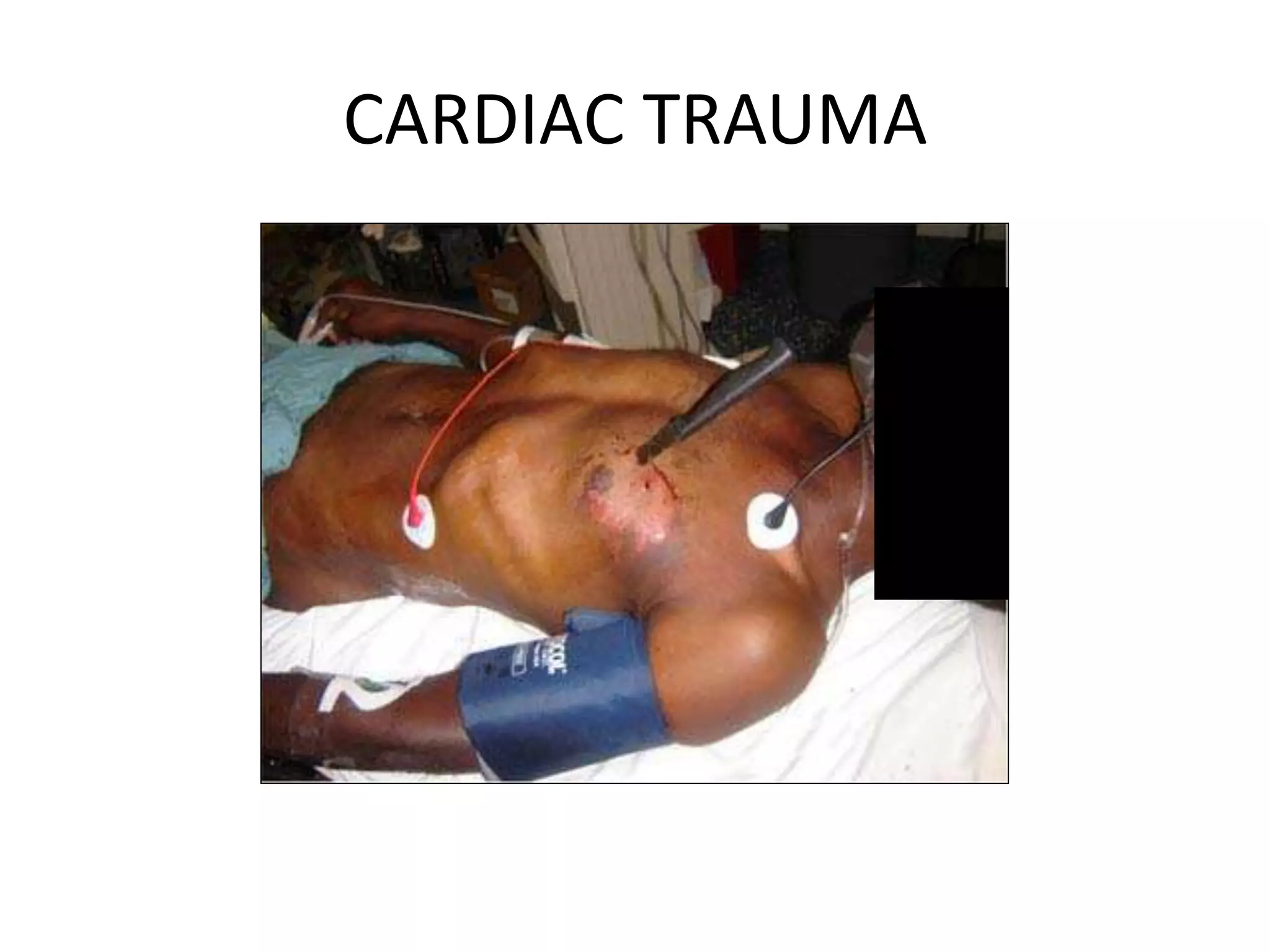 Trauma Thoraks.ppt