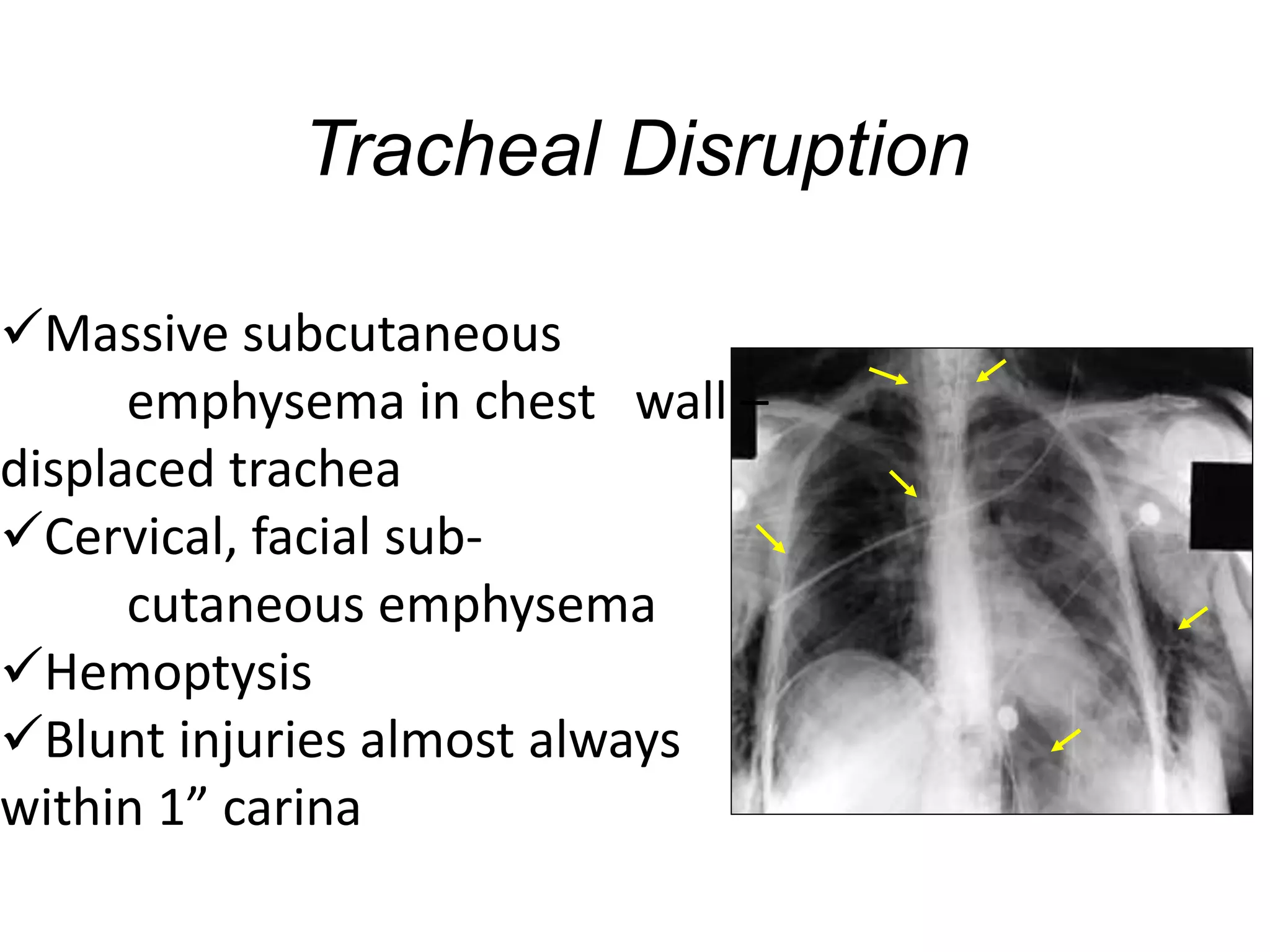Trauma Thoraks.ppt