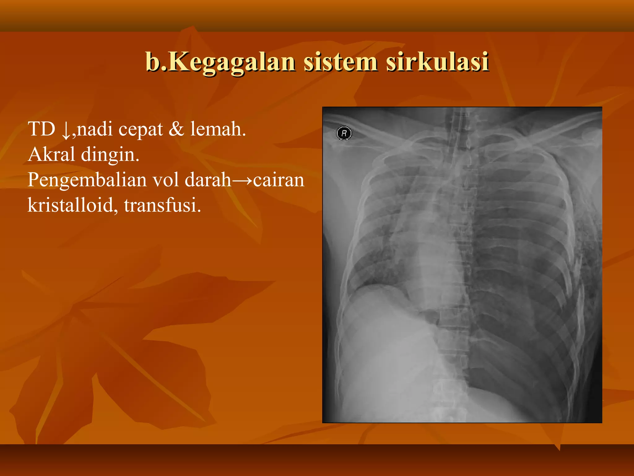 Trauma thorax | PPT