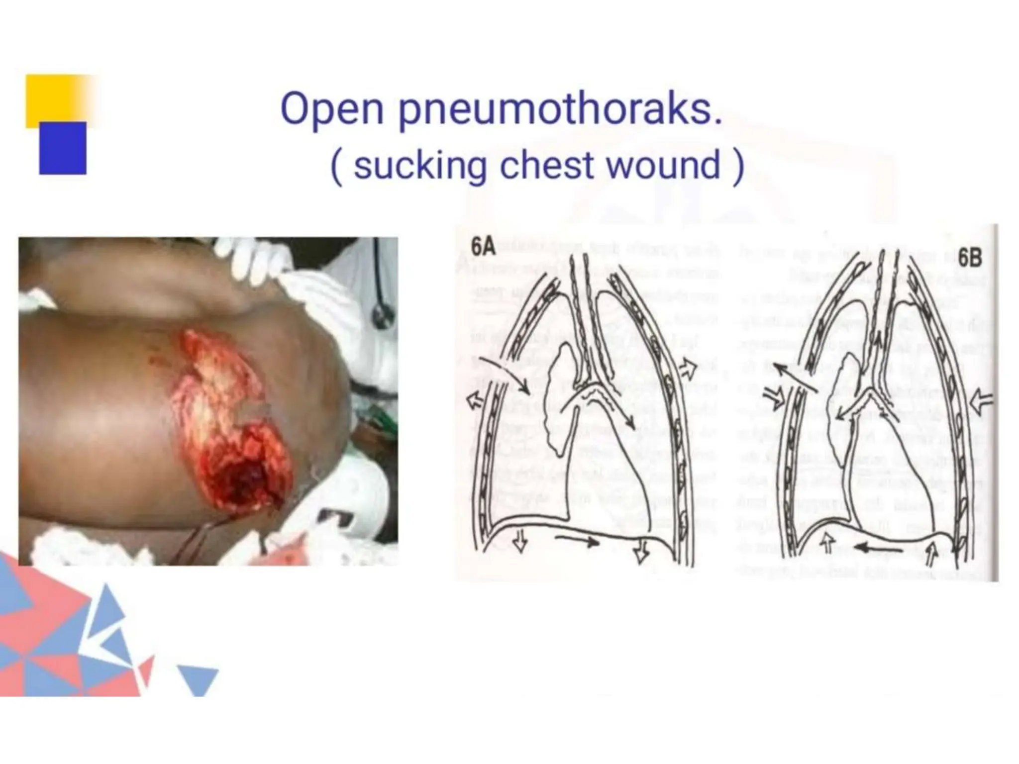 TRAUMA THORAX emergency and how to manage it | PPTX