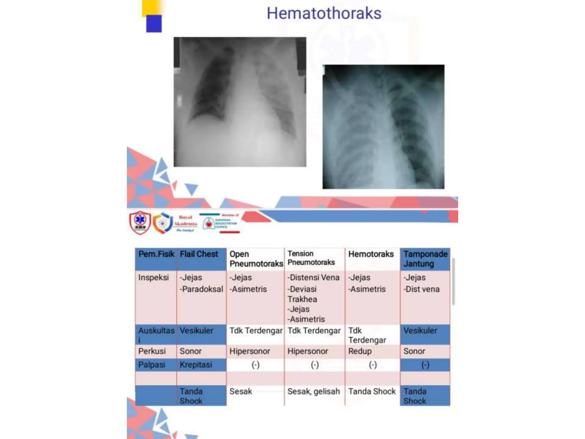 TRAUMA THORAX emergency and how to manage it | PPTX