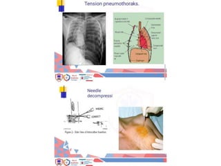 TRAUMA THORAX emergency and how to manage it | PPTX