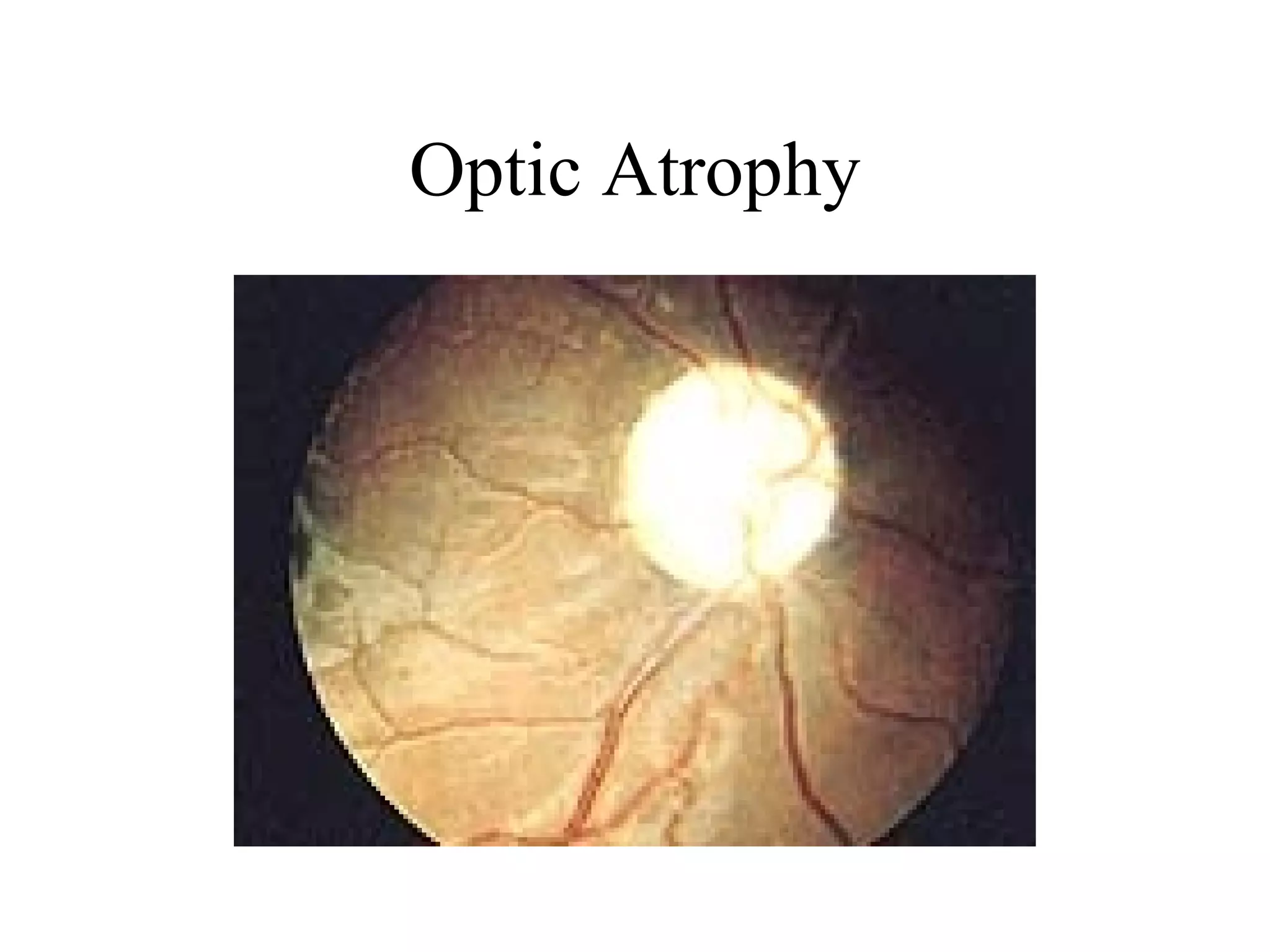 Traumatic Hyphema | PPT